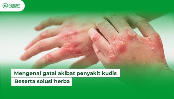 MENGENAL GATAL AKIBAT PENYAKIT KUDIS BESERTA SOLUSI HERBANYA – Attaubah ...